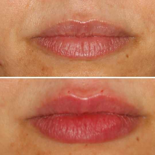 Facial Filler – Preenchimento e Contorno Facial – LORM